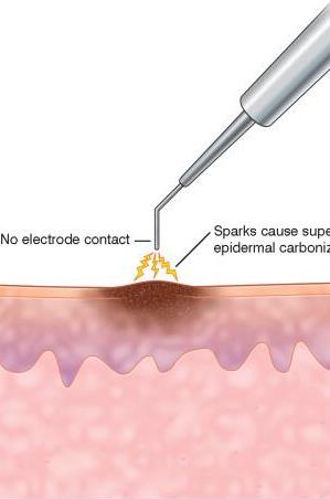 Principles of Plasma Skin Tightening. – Online training